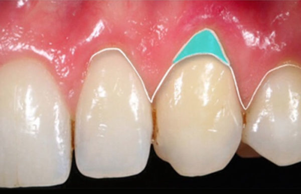 Cirugía Plástica Periodontal - Clínica Dental Dra. Esther de Bustamante